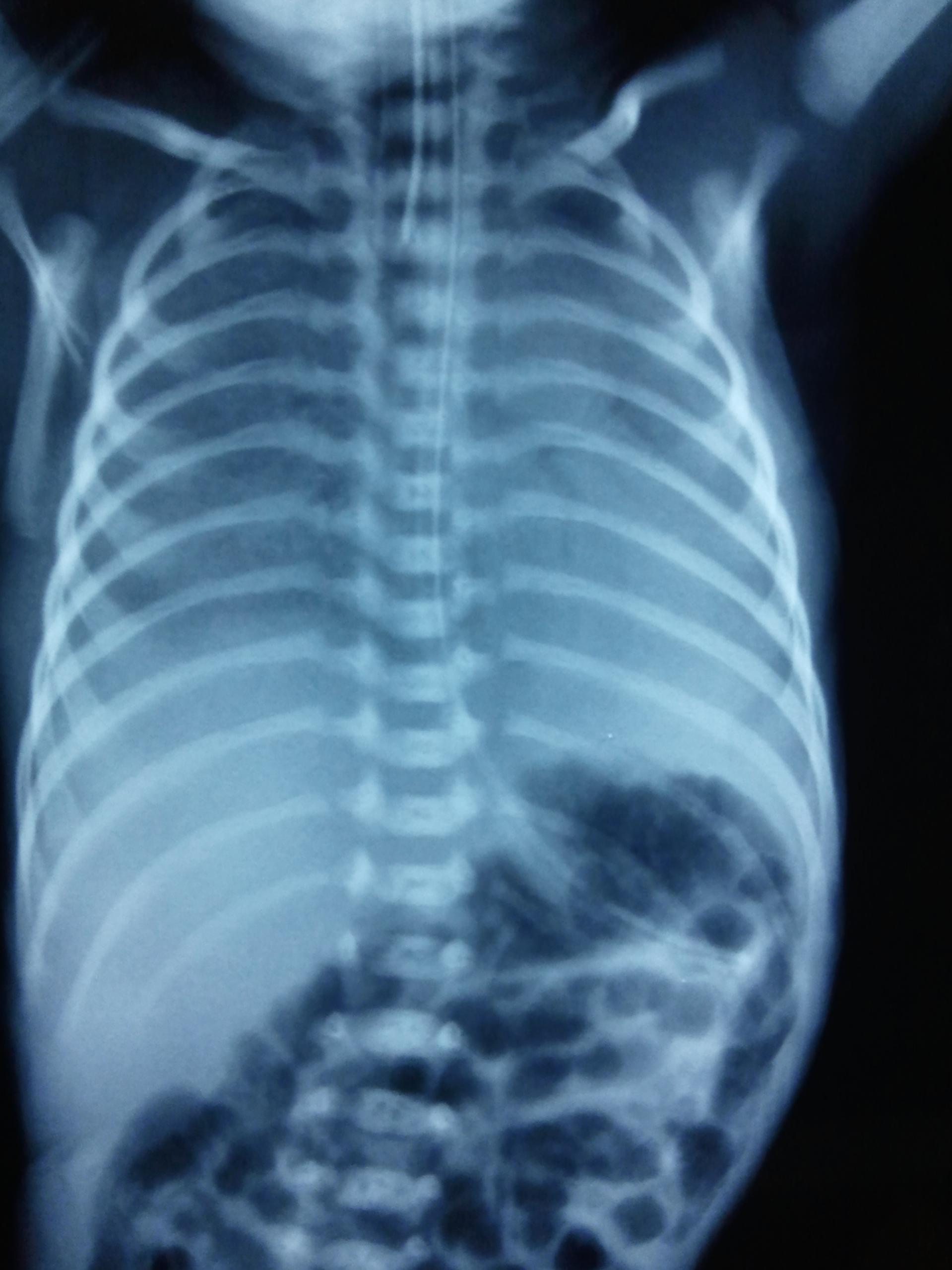 Persistent white out lungs - Respiratory Disorders - 99NICU