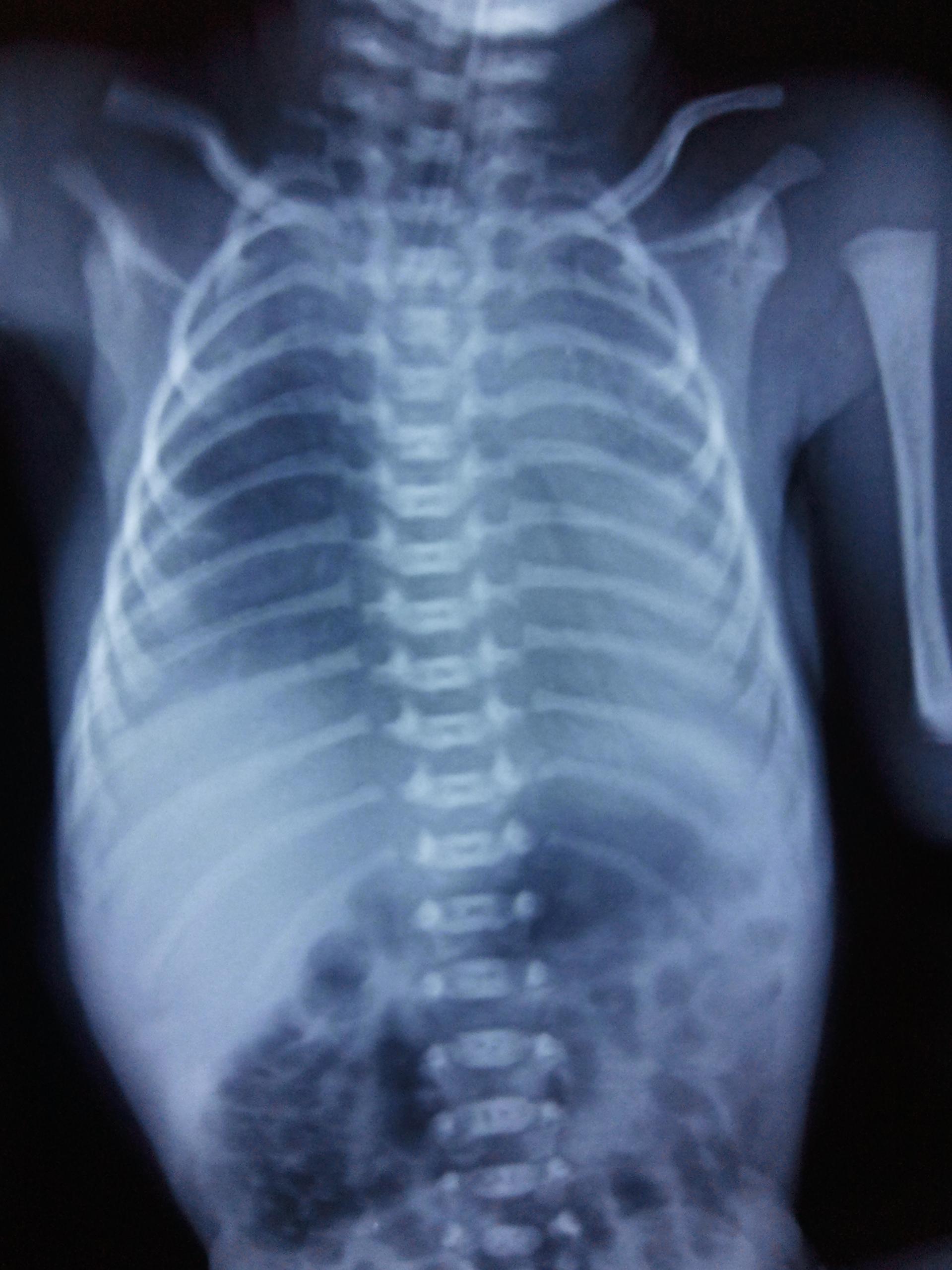 Persistent white out lungs - Respiratory Disorders - 99NICU